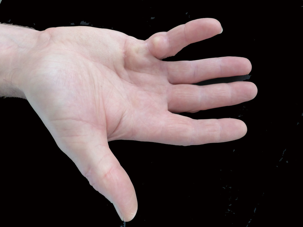 La maladie de Dupuytren | Chirurgie de la main, de l'épaule et du ...