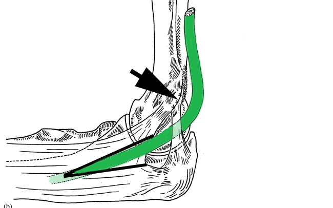 Compression du nerf ulnaire | Chirurgie de la main, de l'épaule et du ...