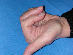 Ténolyse des tendons fléchisseurs | Chirurgie de la main, de l'épaule ...