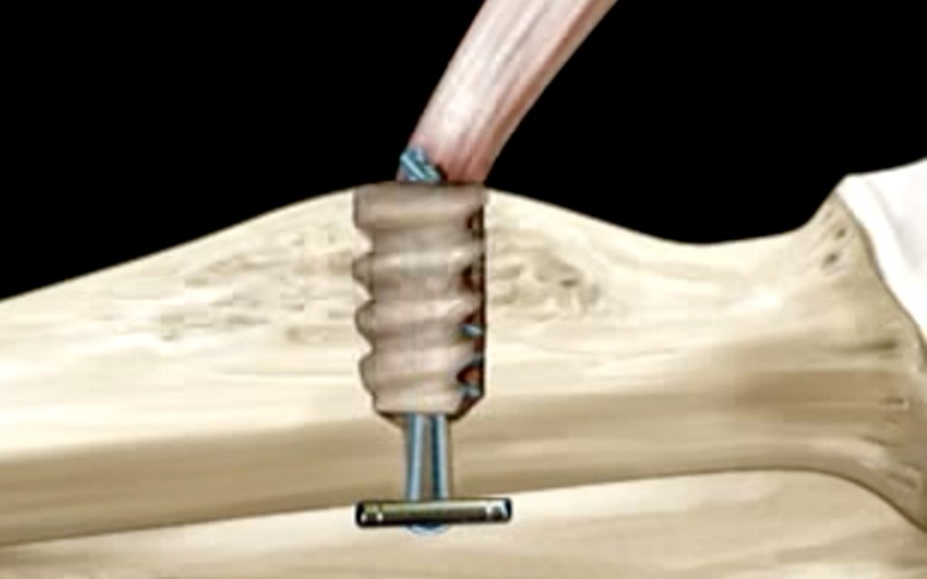 Rupture du biceps distal au coude | Chirurgie de la main, de l'épaule ...