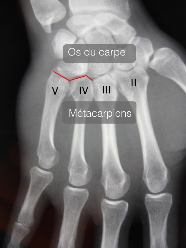 Fractures de la base des métacarpiens | Chirurgie de la main, de l ...